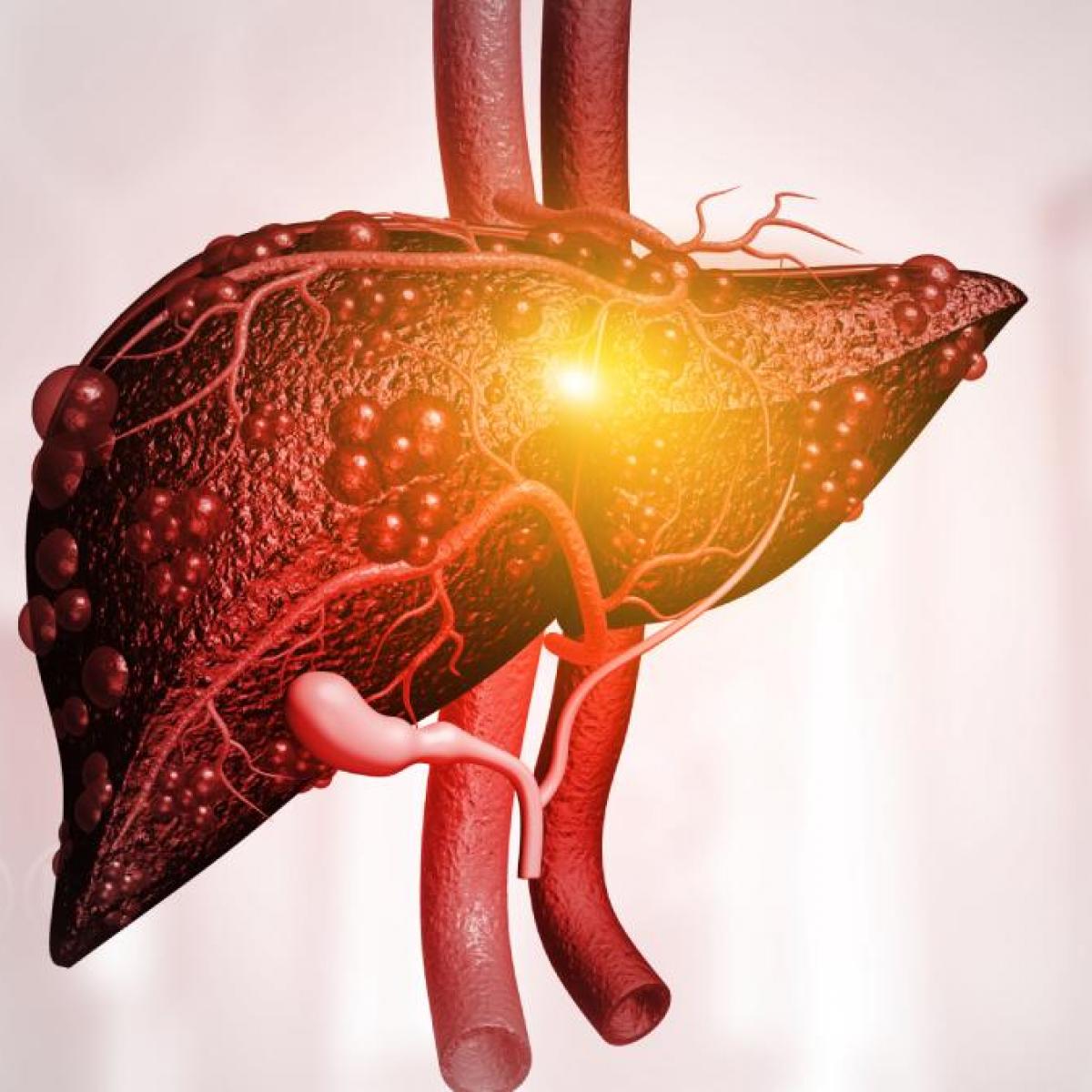 La enfermedad del hígado graso afecta al 25% de los españoles – Salud y ...