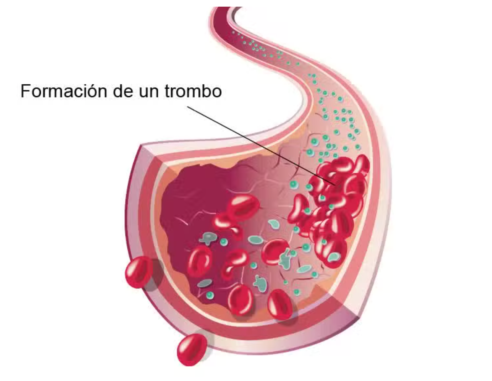 Trombosis venosa: la mujer se enfrenta a un mayor riesgo en ciertas ...